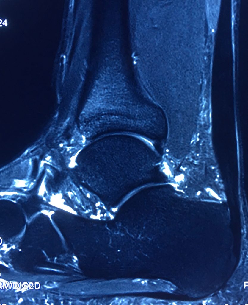 Achilles Sehnen Tendinopathie Tendinitis | Priv.-Doz. Peter Bock, MD